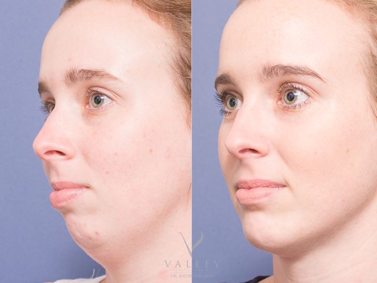 Chin Surgery Brisbane | Genioplasty | Valley Plastic Surgery